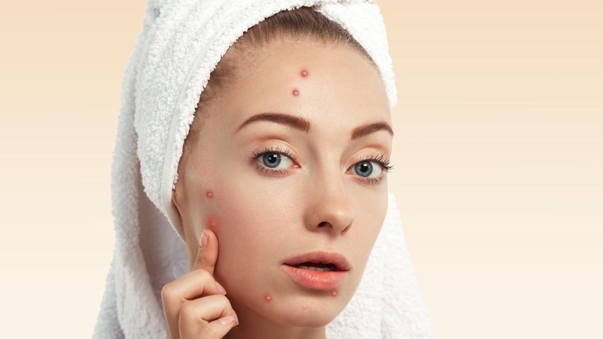 Rekomendasi 5 Acne Patch untuk Perlindungan Jerawat Seharian ...