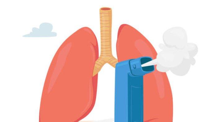Dokter Spesialis Paru dan Pernapasan Sebut Pencetus Penyakit Asma ...