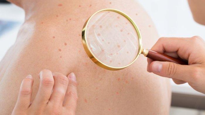 Apakah Jerawat Punggung Tanda Adanya Infeksi Jamur? - TribunHealth.com