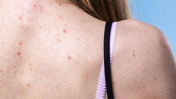 Apakah Jerawat Punggung Tanda Adanya Infeksi Jamur? - TribunHealth.com