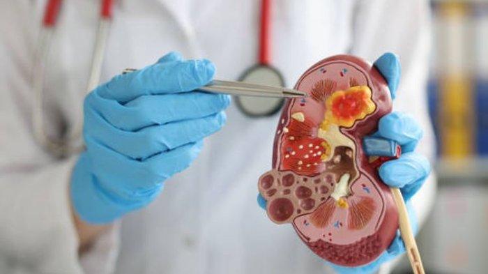 Mitos dan Fakta dari Penyakit Lupus, Apakah Penyakit Lupus Menular ...