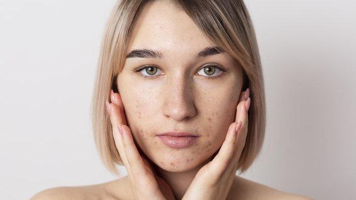 Dokter Tilla, Apa Itu Skin Barrier yang Kini Banyak Dibicarakan ...